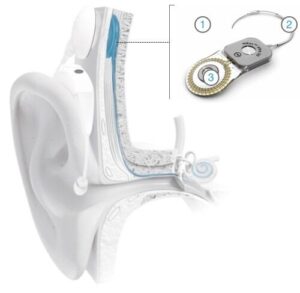 Cochlear Implant - External and Internal Components - Cochlear Implants ...
