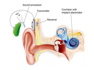 Cost of Cochlear Implants - Cochlear Implants Singapore