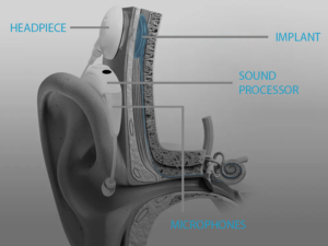 Discovering How a Cochlear Implant Sounds: Advanced Features from ...