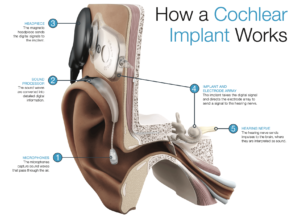 Cochlear Implant: Trusted Service Provider in Singapore